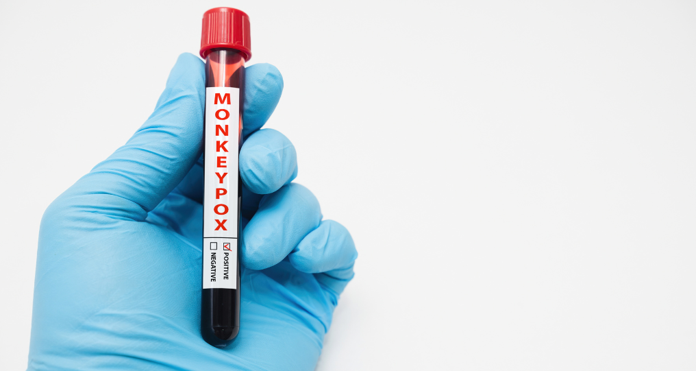 Beždžionių raupai: ką verta žinoti? | Hila