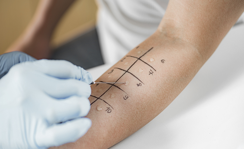 Odos dūrio tyrimas (Prick testas) | Hila